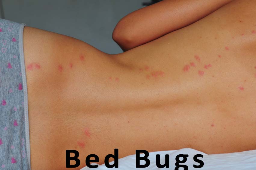 Bug Bites Pestnet Pest Leads Marketing Bug Bites Pestnet Pest Leads Marketing